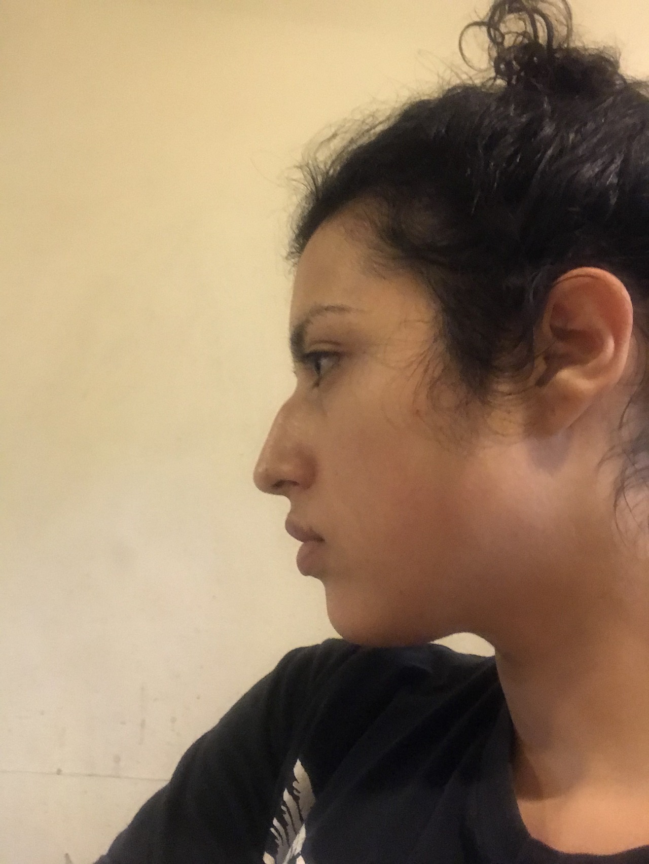 Rhinoplasty?! – One Way Studies